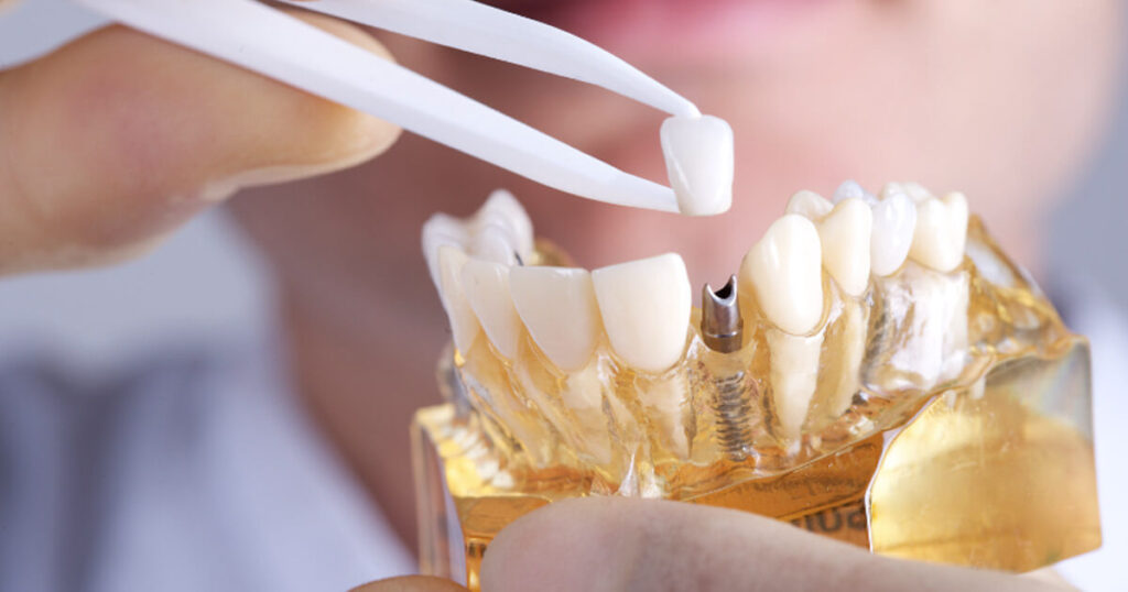 Depois de quanto tempo do implante você pode colocar o dente provisório?