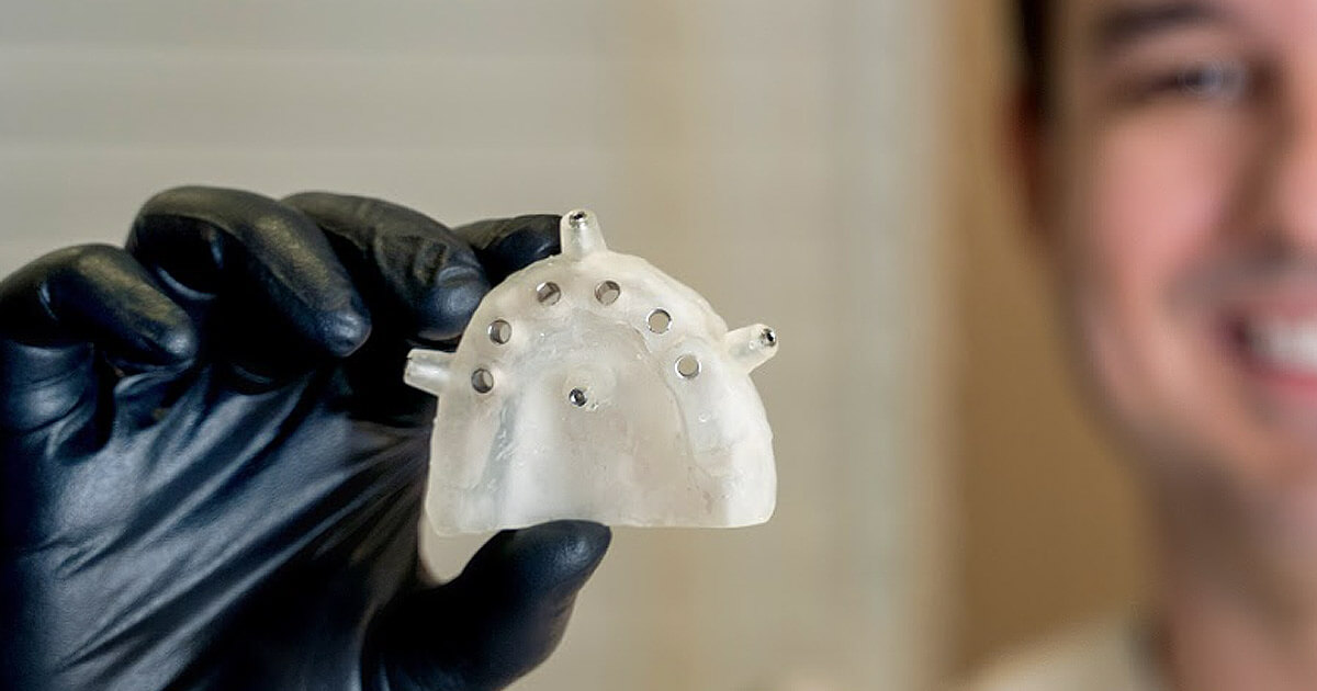 Depois de quanto tempo do implante você pode colocar o dente provisório?